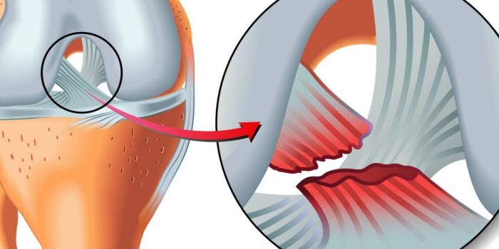Rottura del legamento crociato anteriore: cosa fare una volta rotto ...